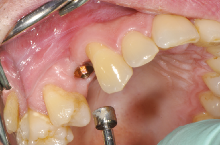 Nuove possibilità cement-free del sistema implantare XCN® Leone: corona ...
