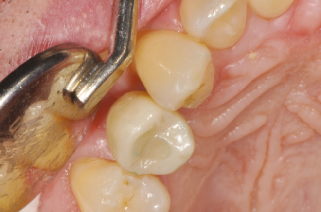 Nuove possibilità cement-free del sistema implantare XCN® Leone: corona ...