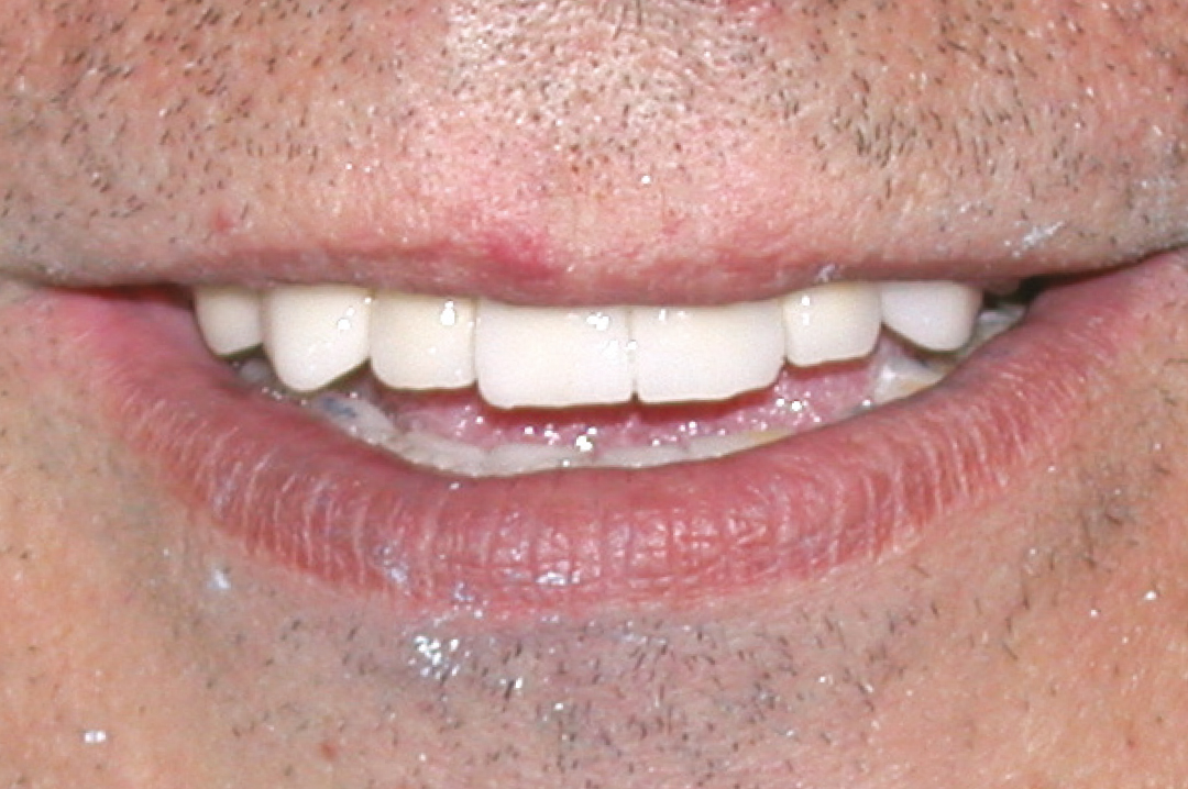 Tratamiento con implantes en un paciente con arcada edéntula ...