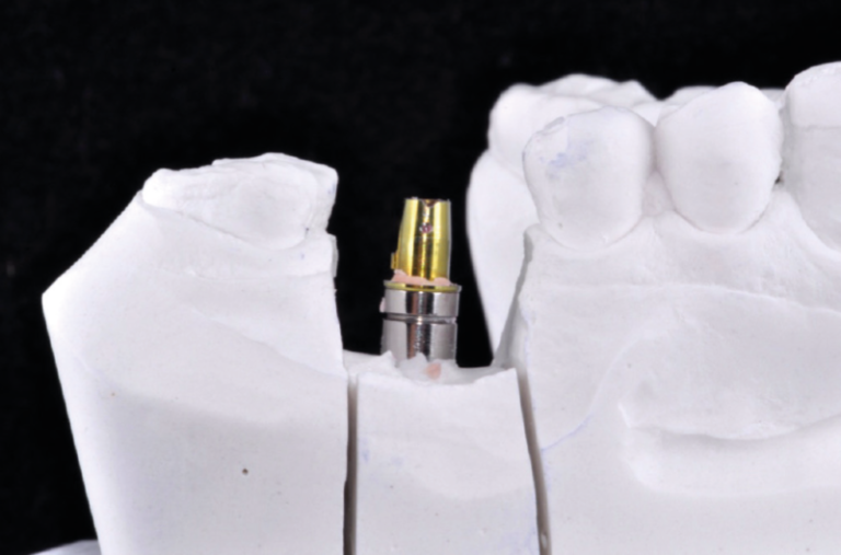 Corona individual en composite sobre implante XCN® y ExaConnect | Casos ...
