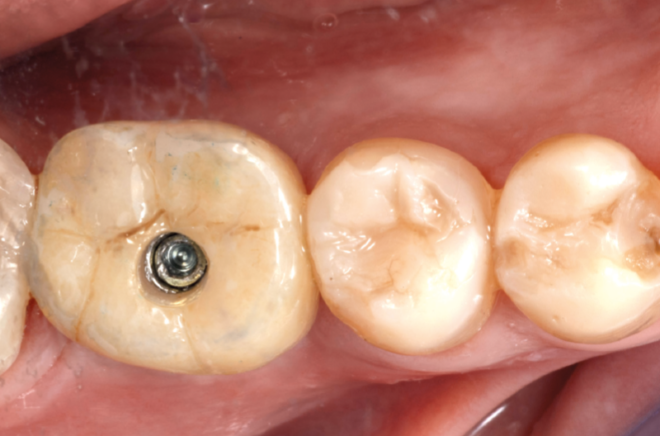 Corona individual en composite sobre implante XCN® y ExaConnect | Casos ...