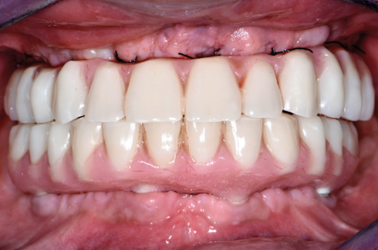 Tratamiento de un paciente totalmente edéntulo con una prótesis fija ...