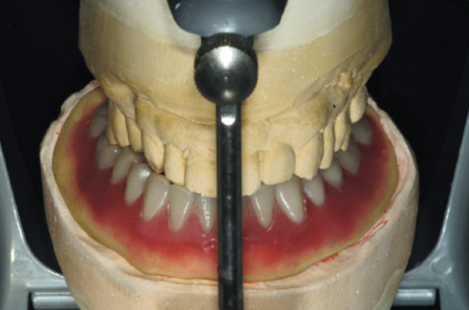 Conometric retention for removable implant-supported prosthesis: a case ...