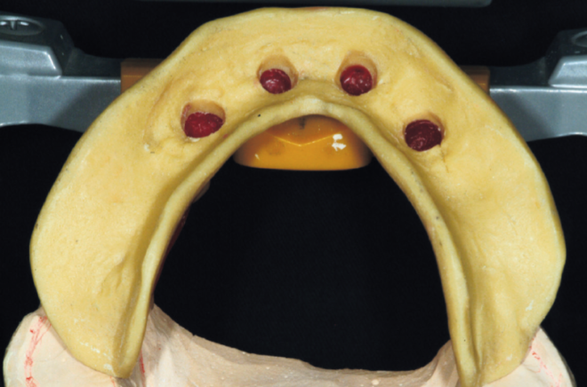 Conometric retention for removable implant-supported prosthesis: a case ...