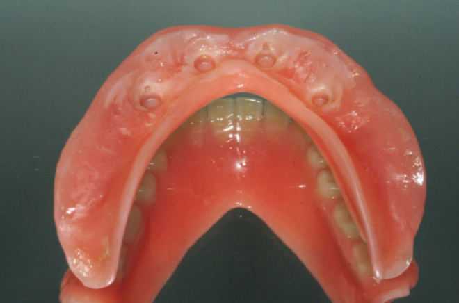 Conometric retention for removable implant-supported prosthesis: a case ...