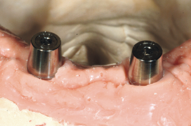 Conometric retention for removable implant-supported prosthesis: a case ...