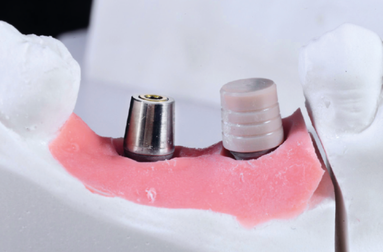 Fabrication of fixed conometric bridges on XCN® implants | Leone ...