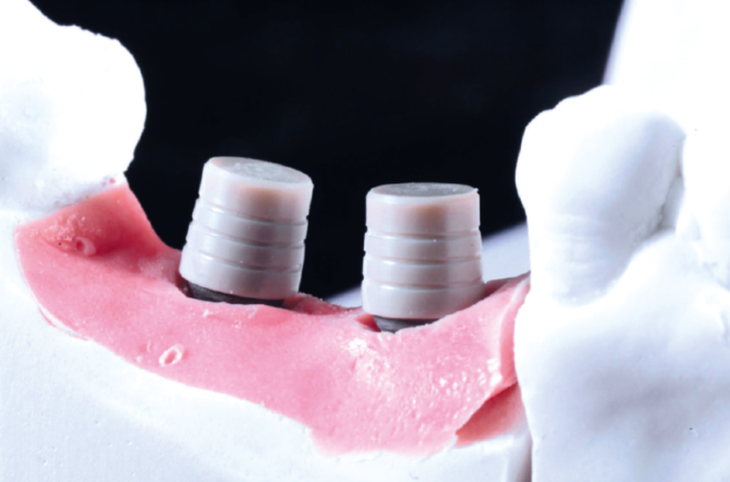 Fabrication of fixed conometric bridges on XCN® implants | Leone ...